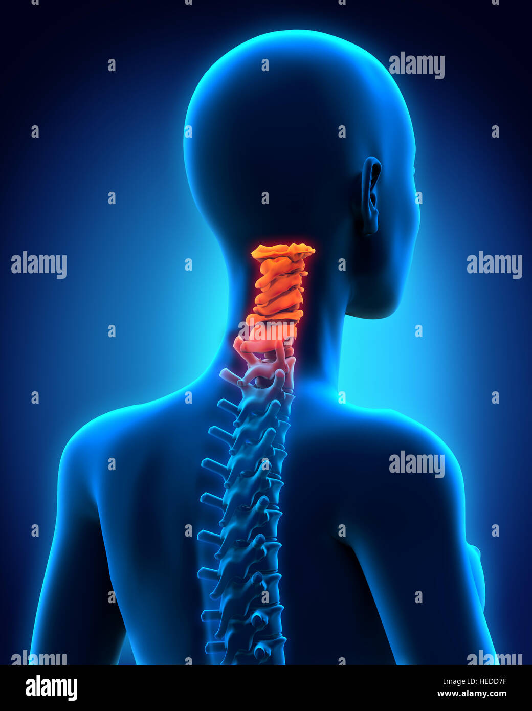 Inflammation medical cervical not woman hi-res stock photography and ...