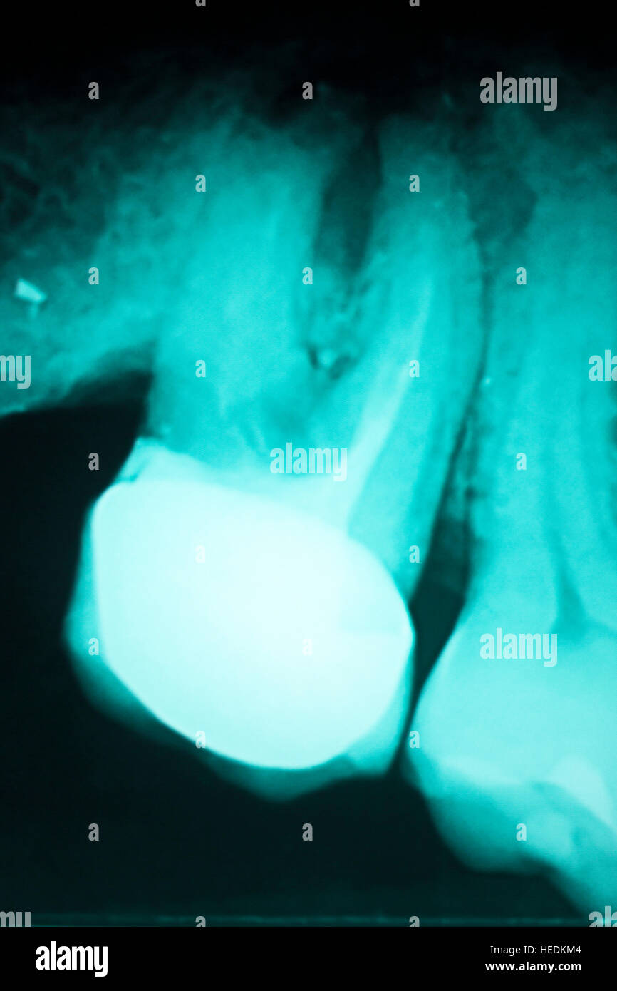Tooth with filling dental x-ray close-up image showing teeth roots, gum ...