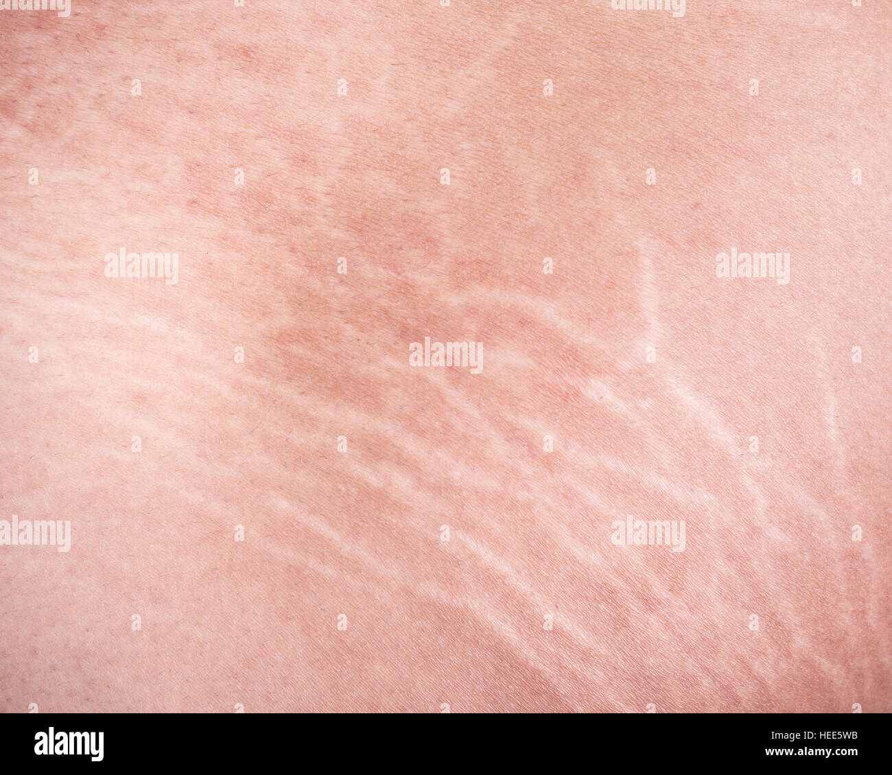 Macro stretch marks of skin on the thigh Stock Photo - Alamy