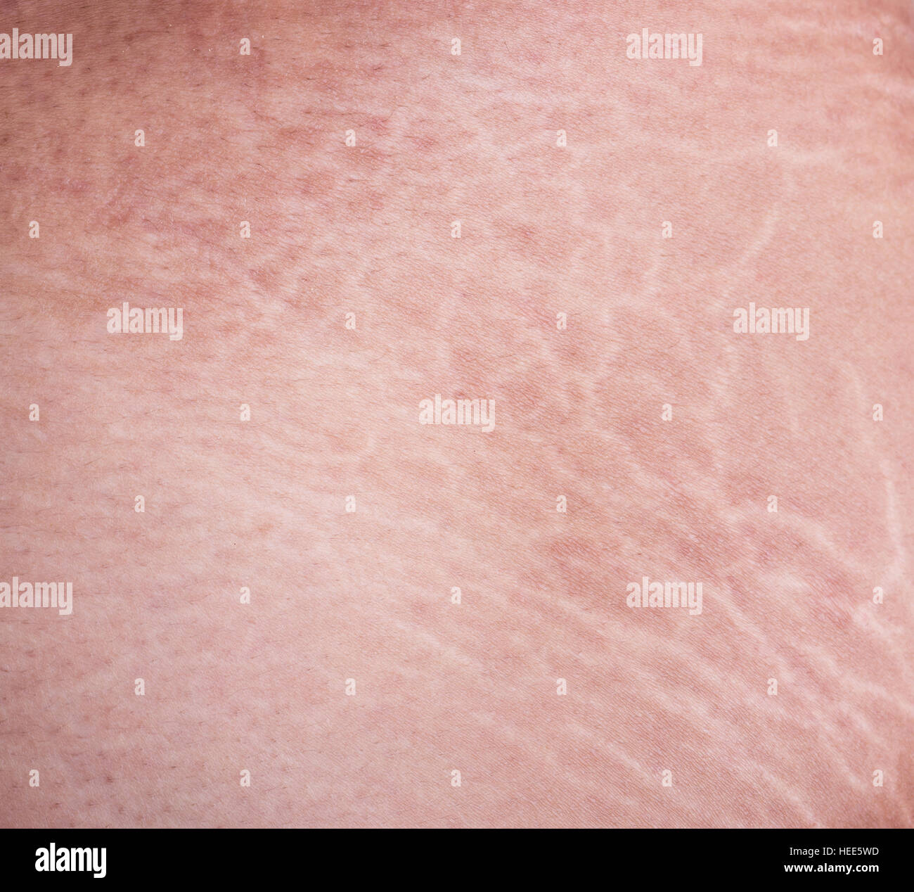 Macro stretch marks of skin on the thigh Stock Photo - Alamy