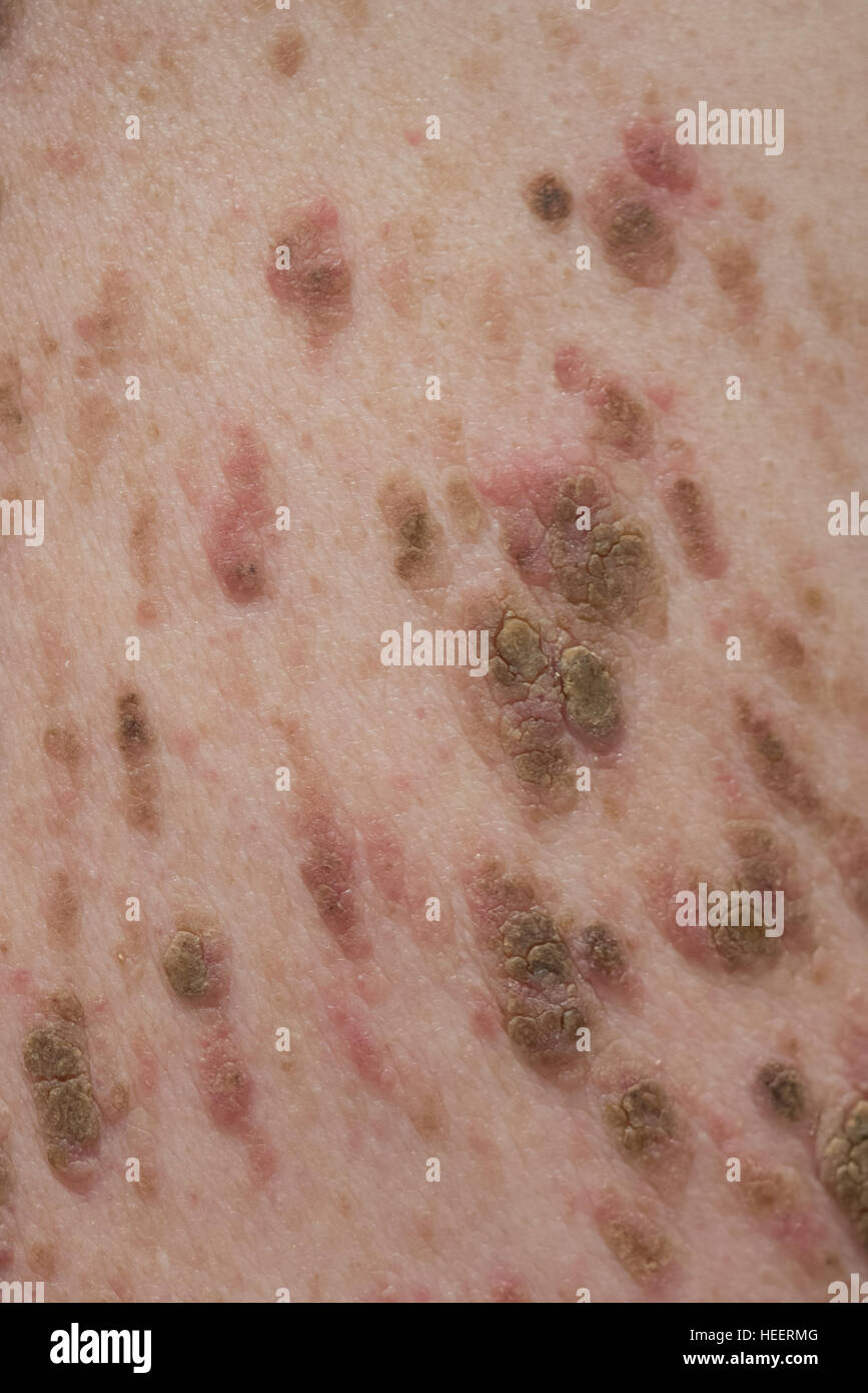 Seborrheic keratosis hi-res stock photography and images - Alamy