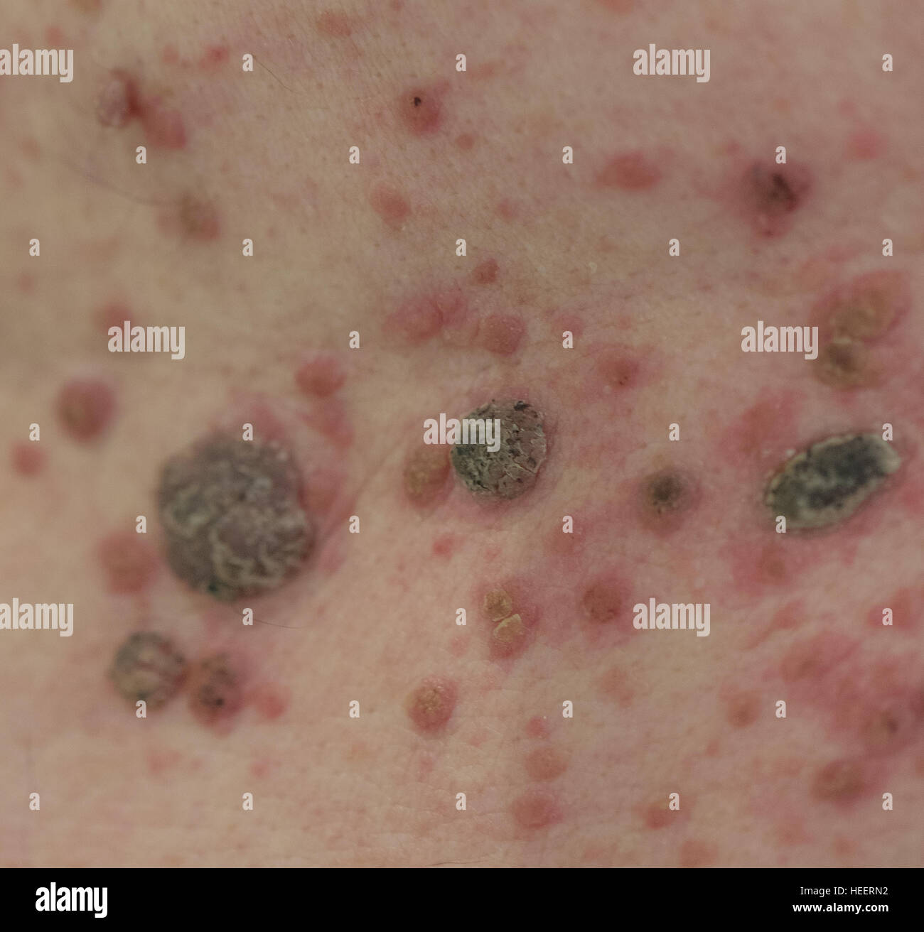 Dermatosis papulosa nigra hi-res stock photography and images - Alamy