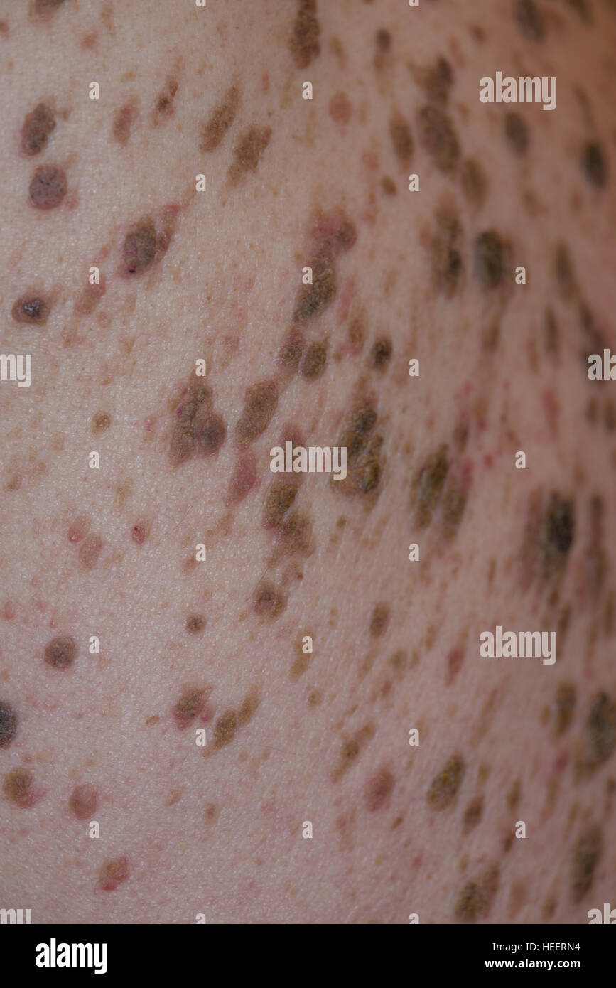 Mans back with mass of moles and infection Stock Photo - Alamy