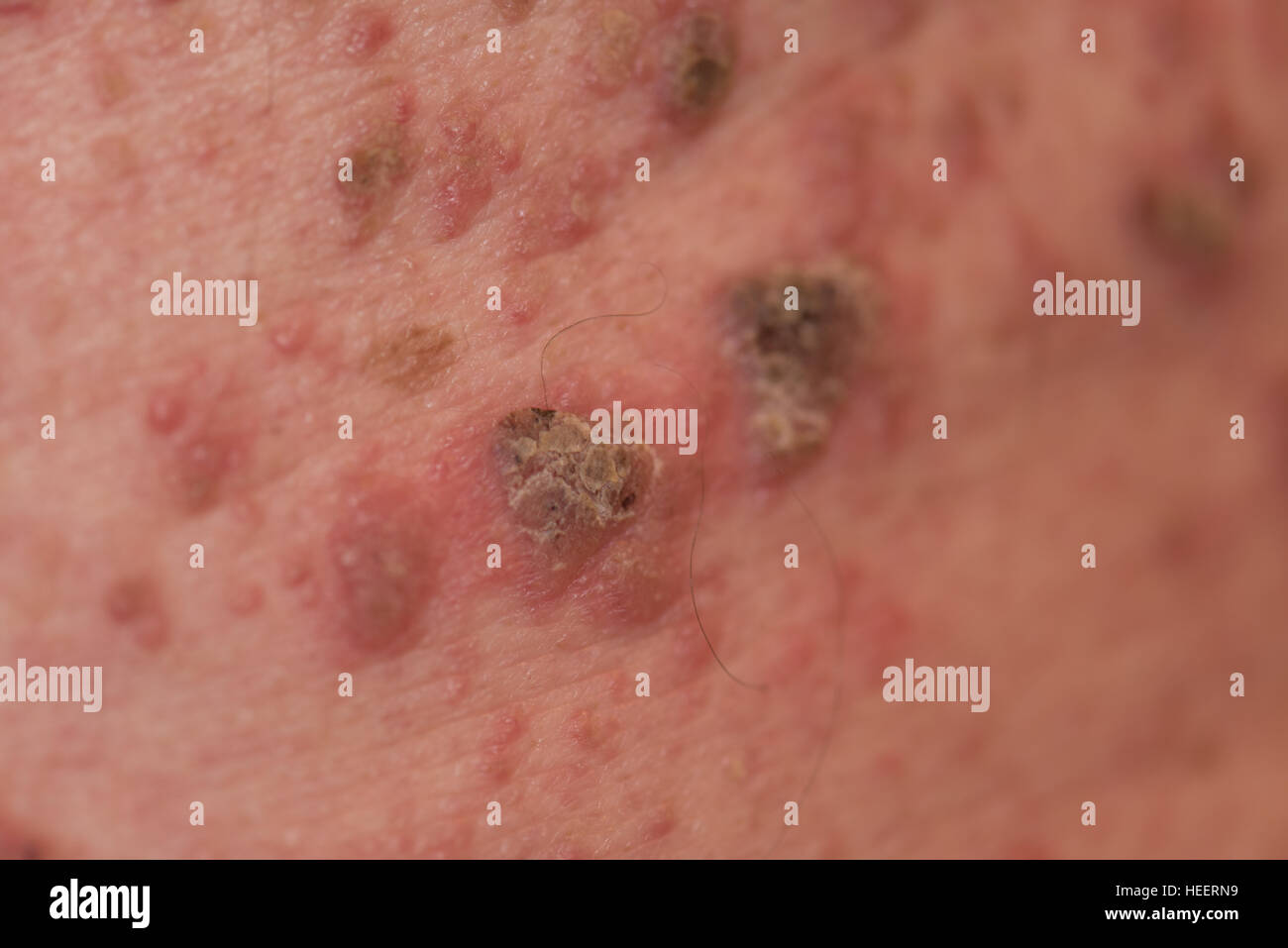 Mans back with mass of moles and infection Stock Photo - Alamy