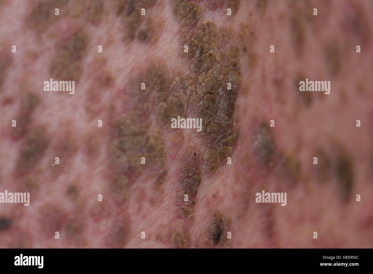 Seborrheic keratosis hi-res stock photography and images - Alamy