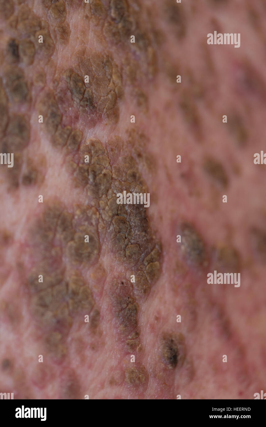 Seborrheic keratosis hi-res stock photography and images - Alamy