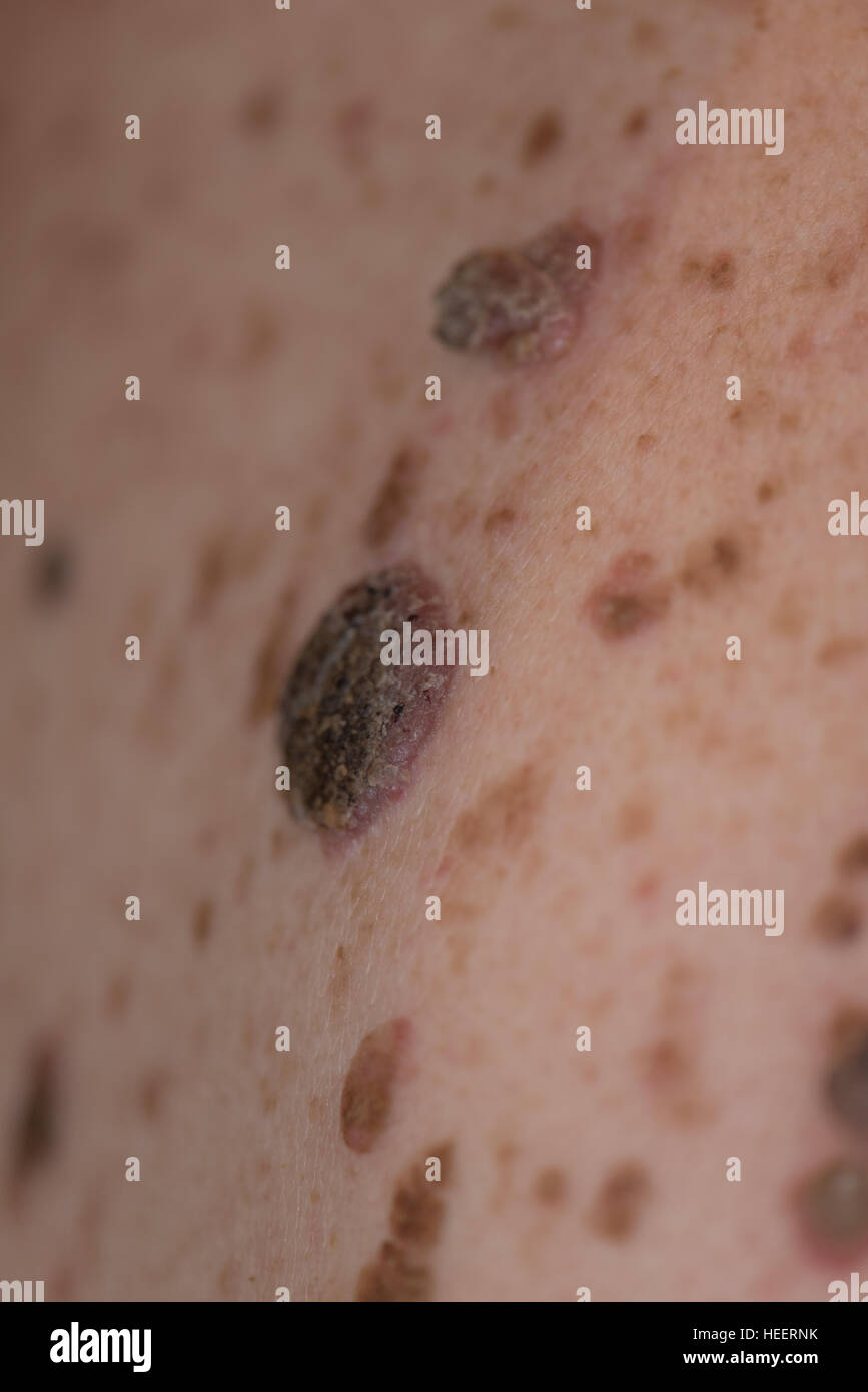 Seborrheic keratosis hi-res stock photography and images - Alamy
