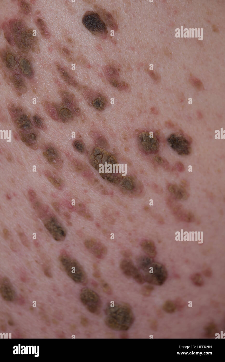 Seborrheic keratosis hi-res stock photography and images - Alamy