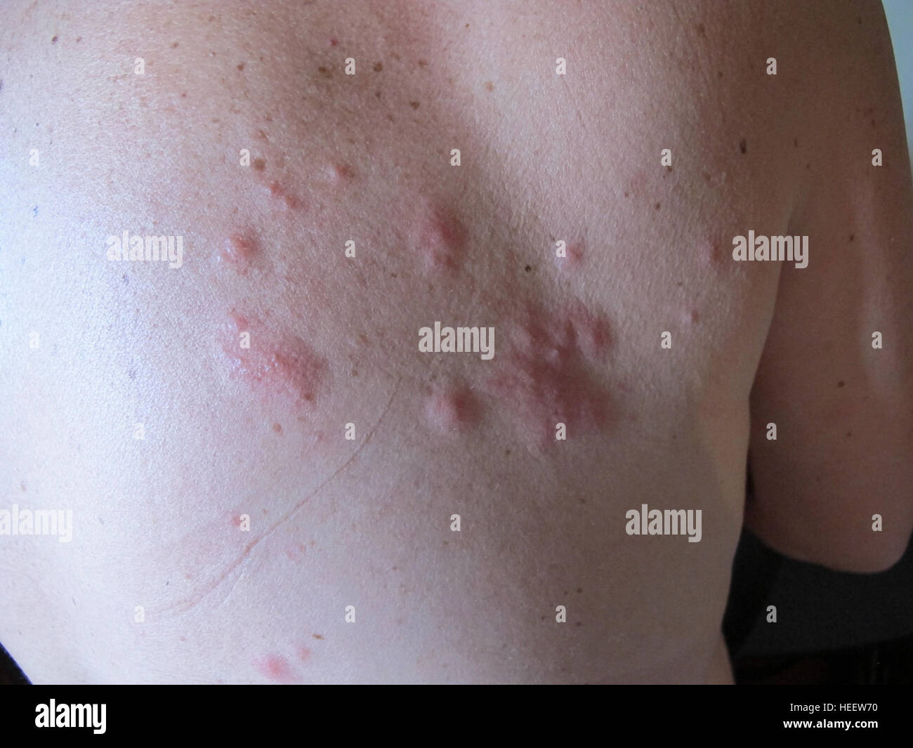 Mosquito Bites On Back