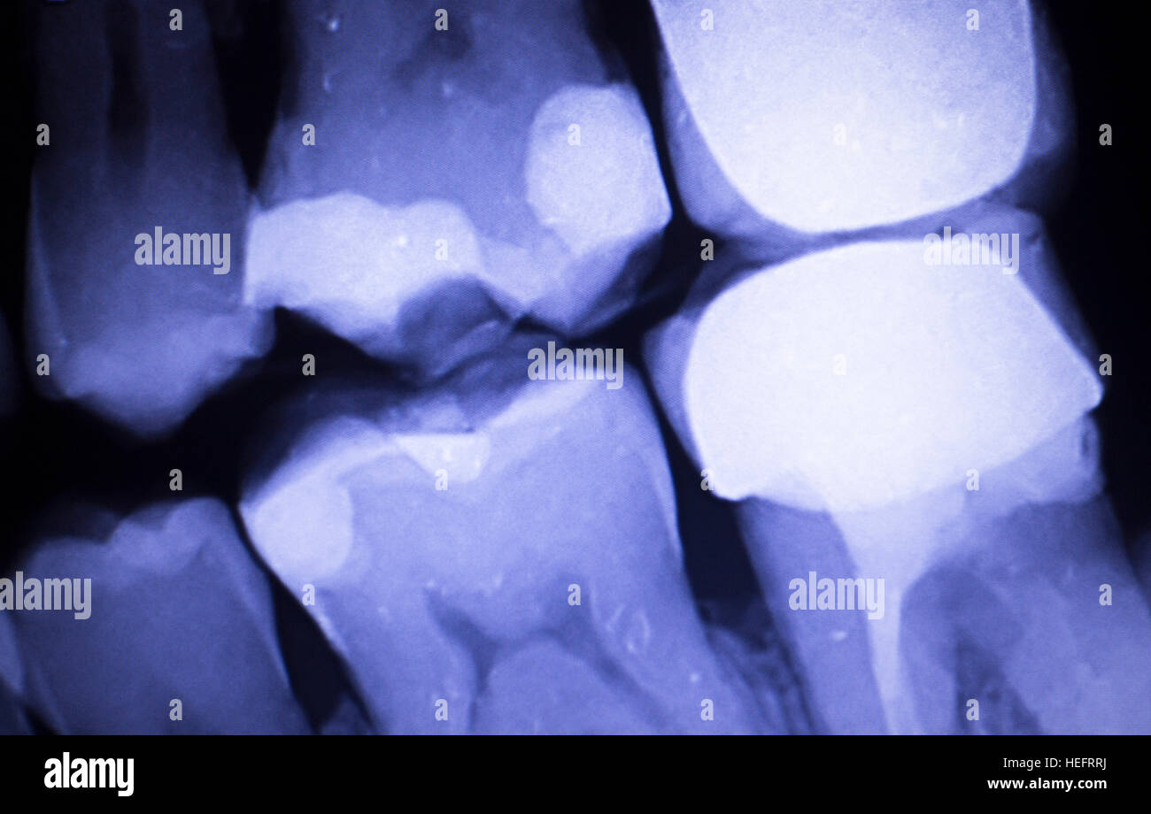 Tooth with filling dental x-ray close-up image showing teeth roots, gum ...