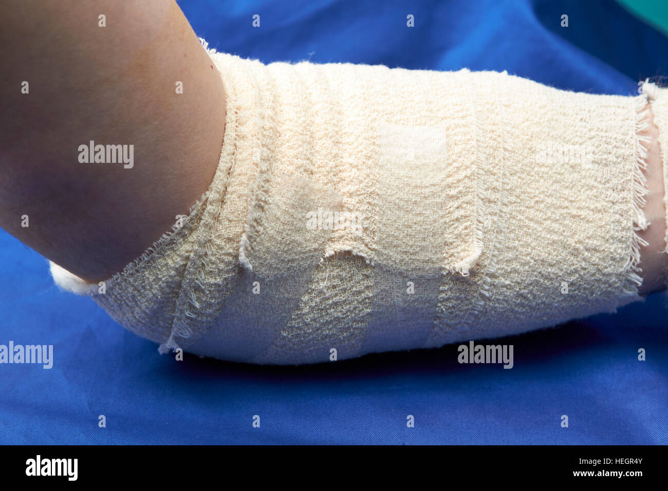 Tennis Elbow Surgery