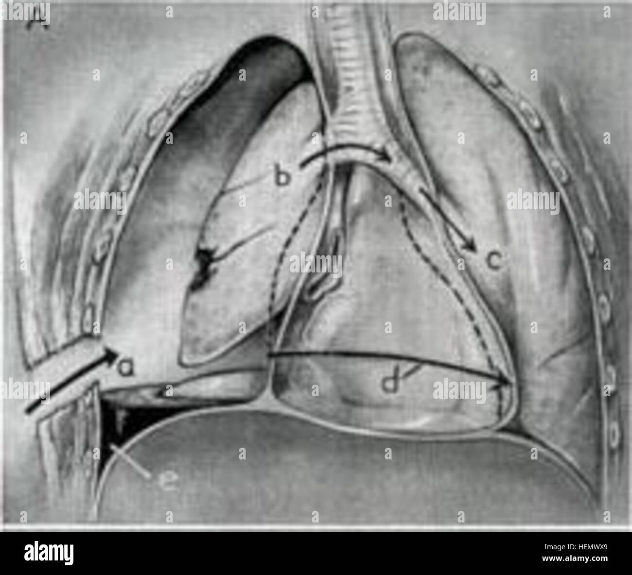 Sucking chest wound mechanicsA Stock Photo - Alamy