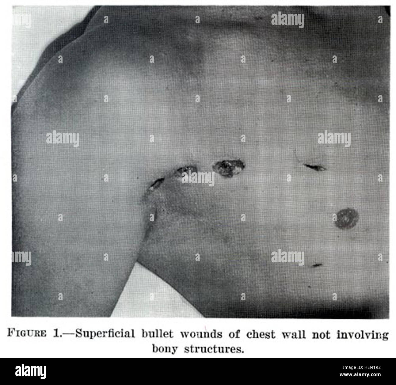 Superficial wound hi-res stock photography and images - Alamy