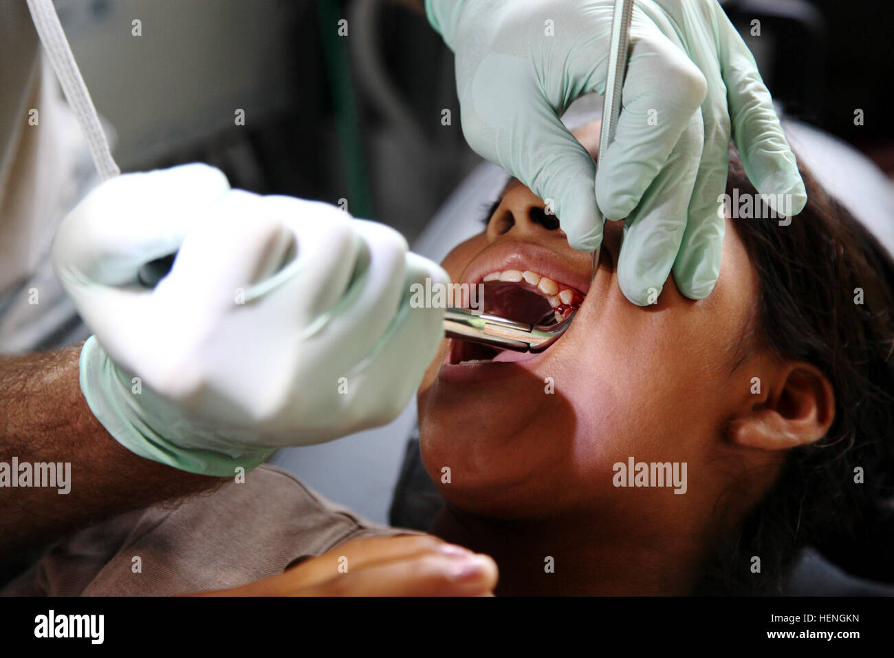 U.S. Army Col. Brad Kohl removes a tooth from Guatemalan woman at a ...