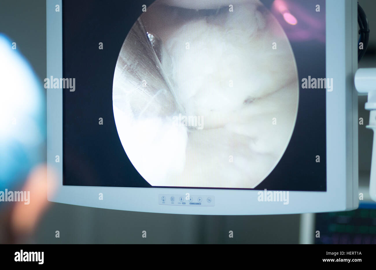 Meniscus repair hi-res stock photography and images - Alamy