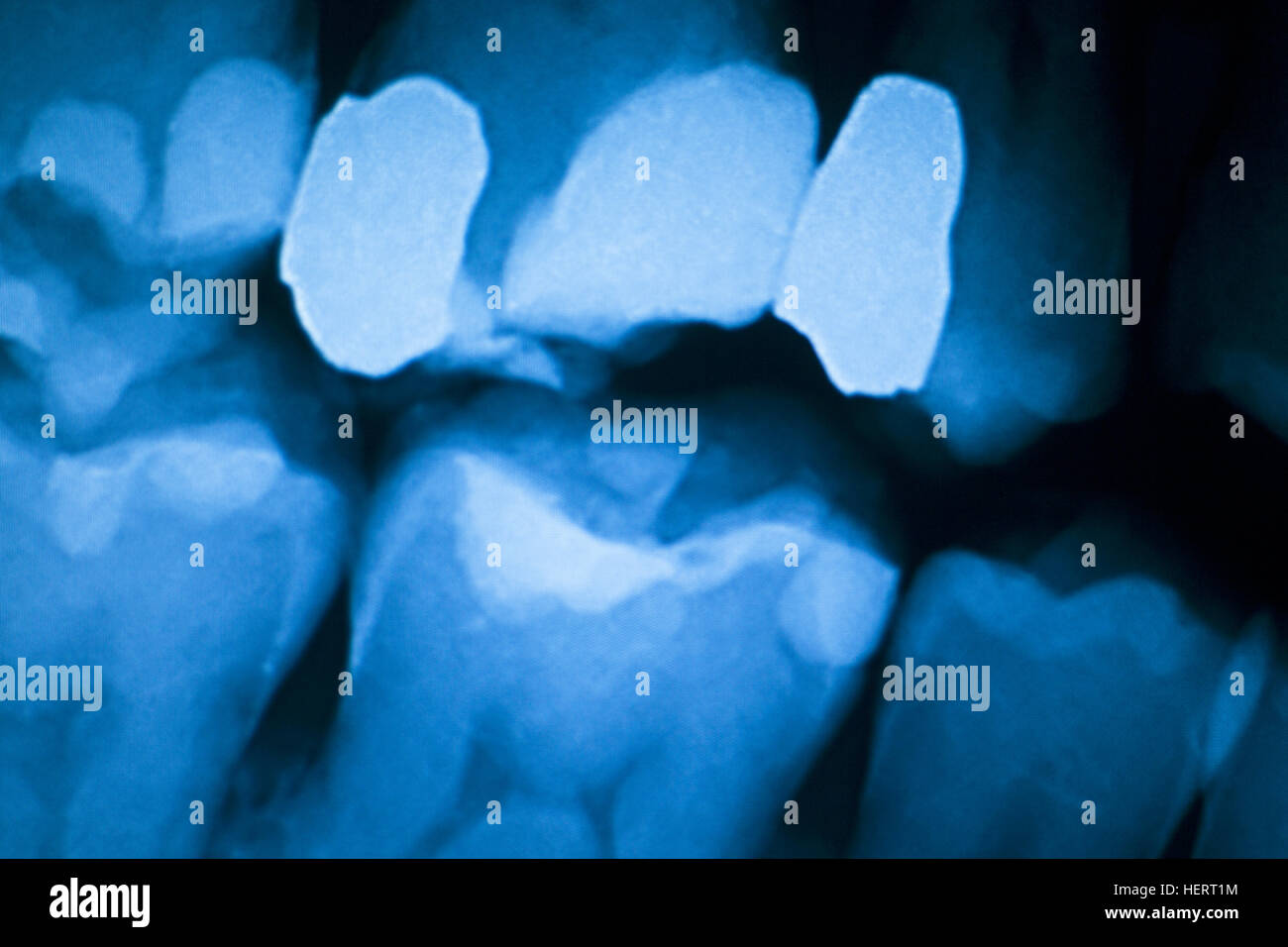 Tooth with filling dental x-ray close-up image showing teeth roots, gum ...