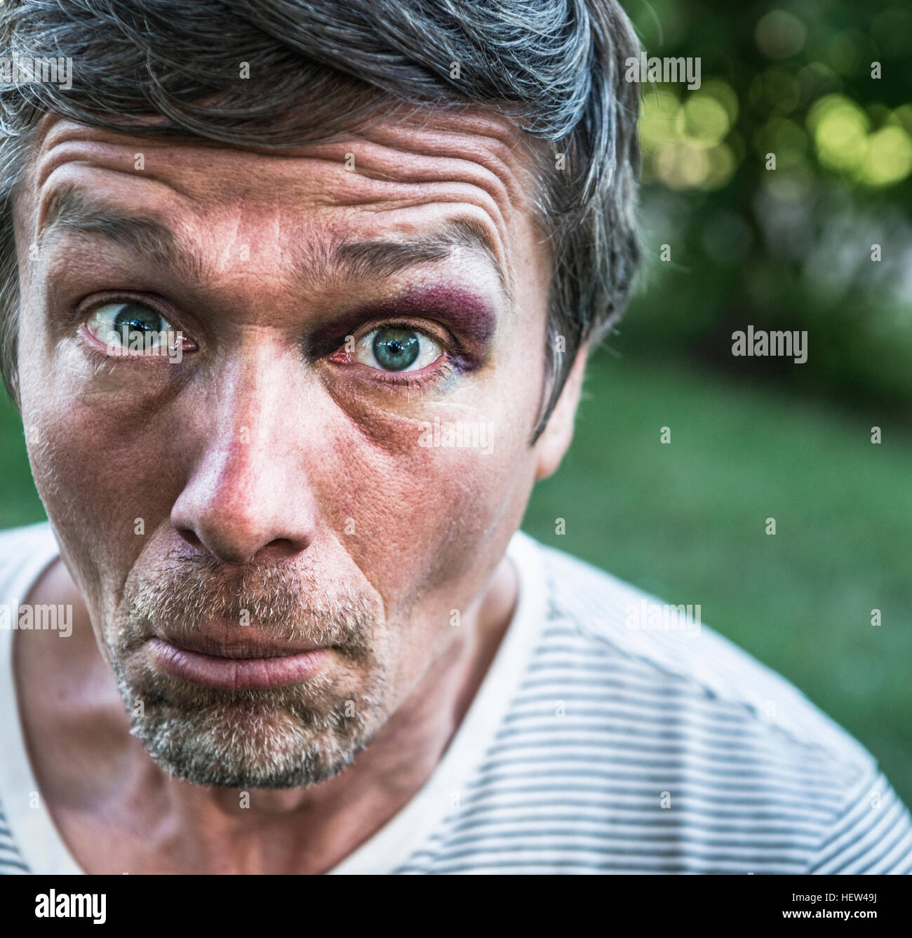 Black eye hi-res stock photography and images - Alamy