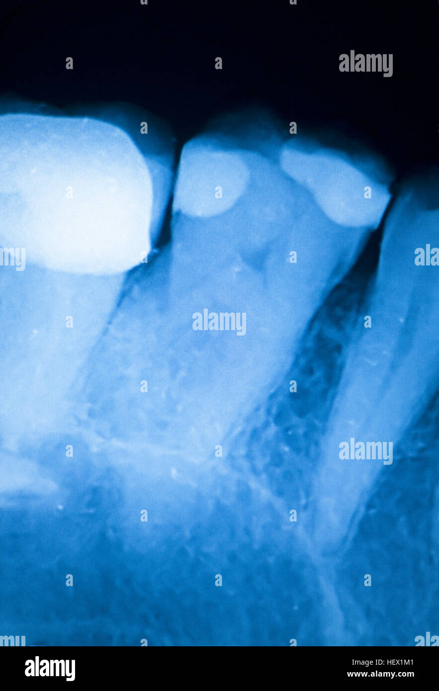 Tooth with filling dental x-ray close-up image showing teeth roots, gum ...