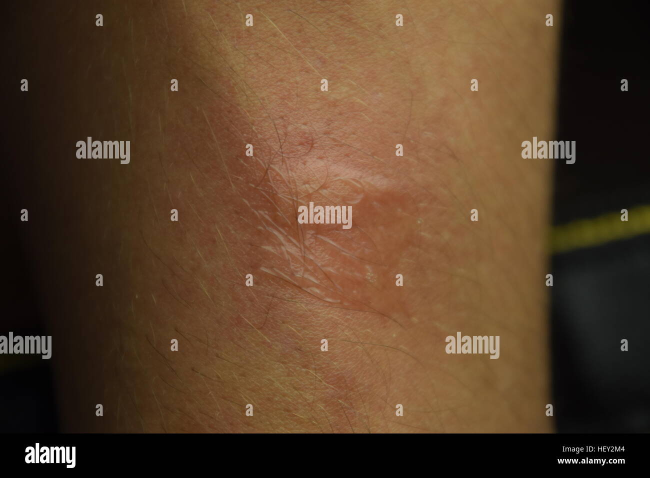 Allergy skin. Allergic reactions on the skin in the form of swelling ...