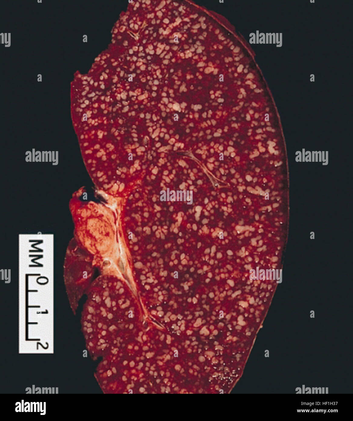 Follicular lymphoma, spleen Stock Photo - Alamy