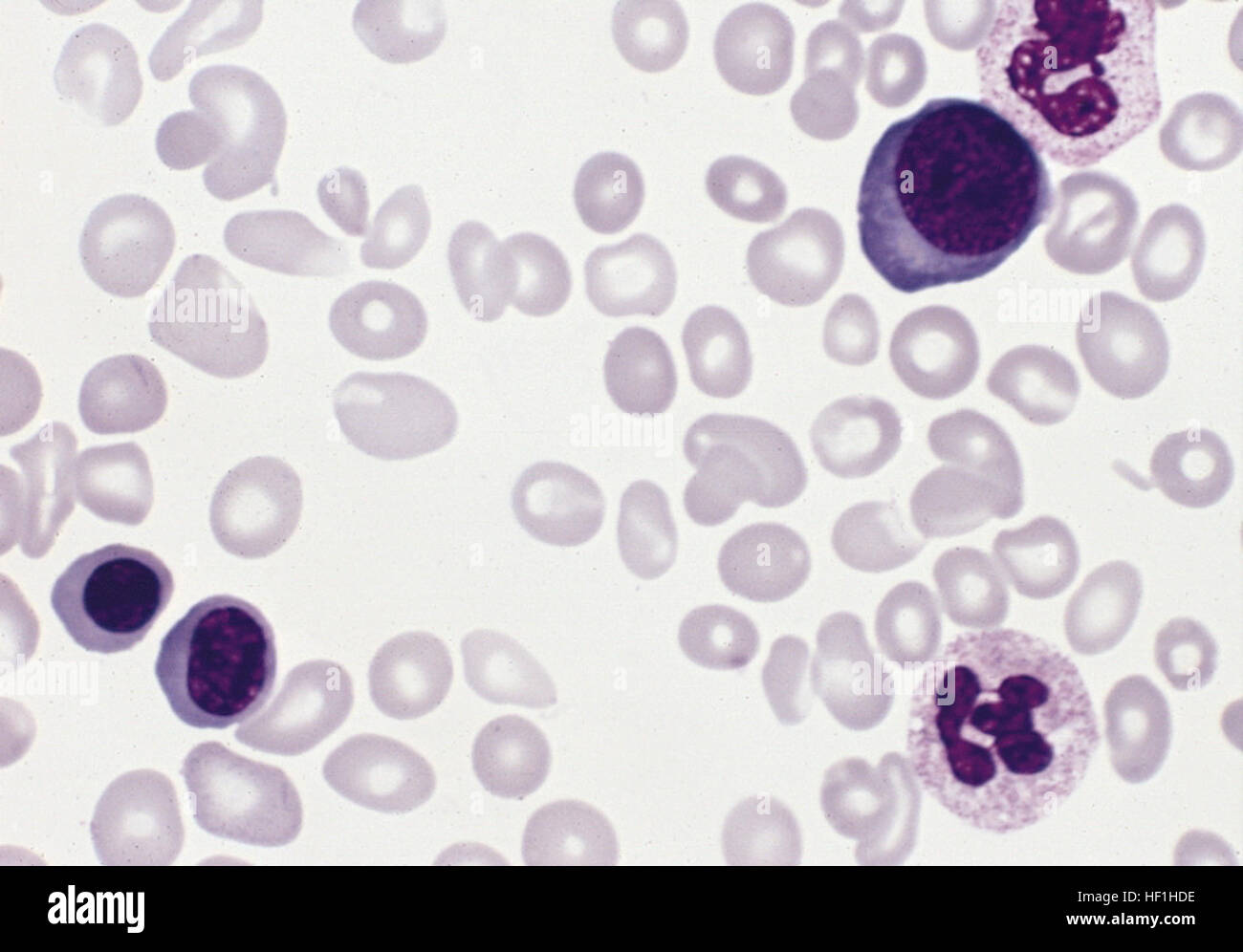 Polycythemia vera, blood smear Stock Photo - Alamy