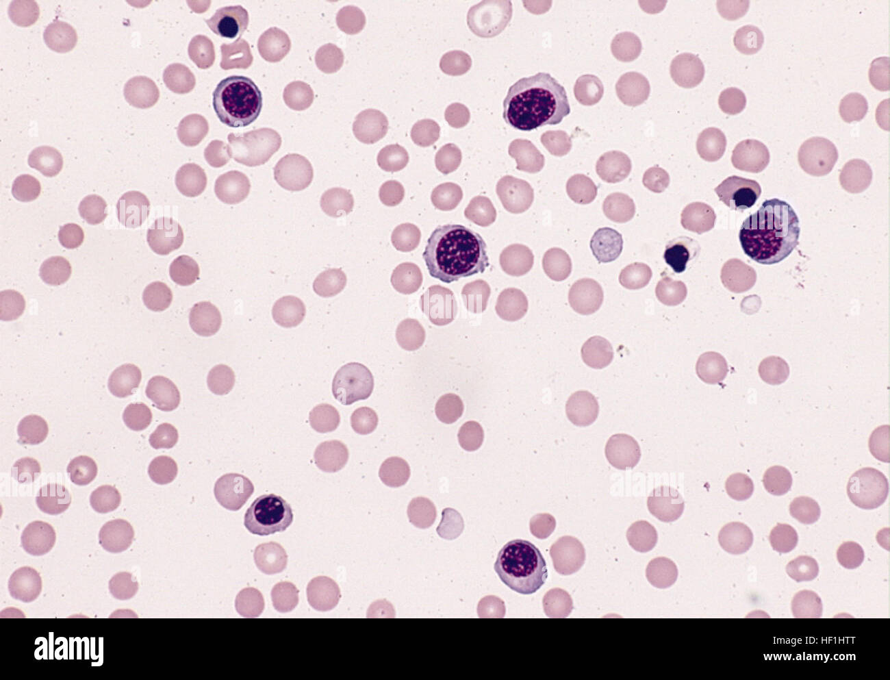 AML-M6, blood smear Stock Photo - Alamy