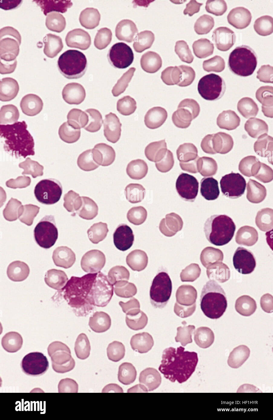 Chronic lymphocytic leukemia hi-res stock photography and images - Alamy