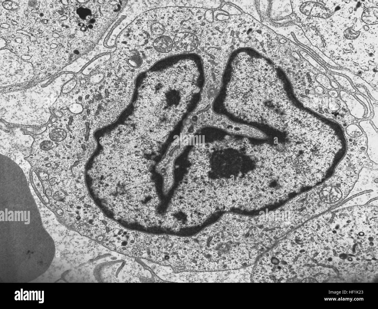 AML-M5B, promonocyte, TEM Stock Photo - Alamy