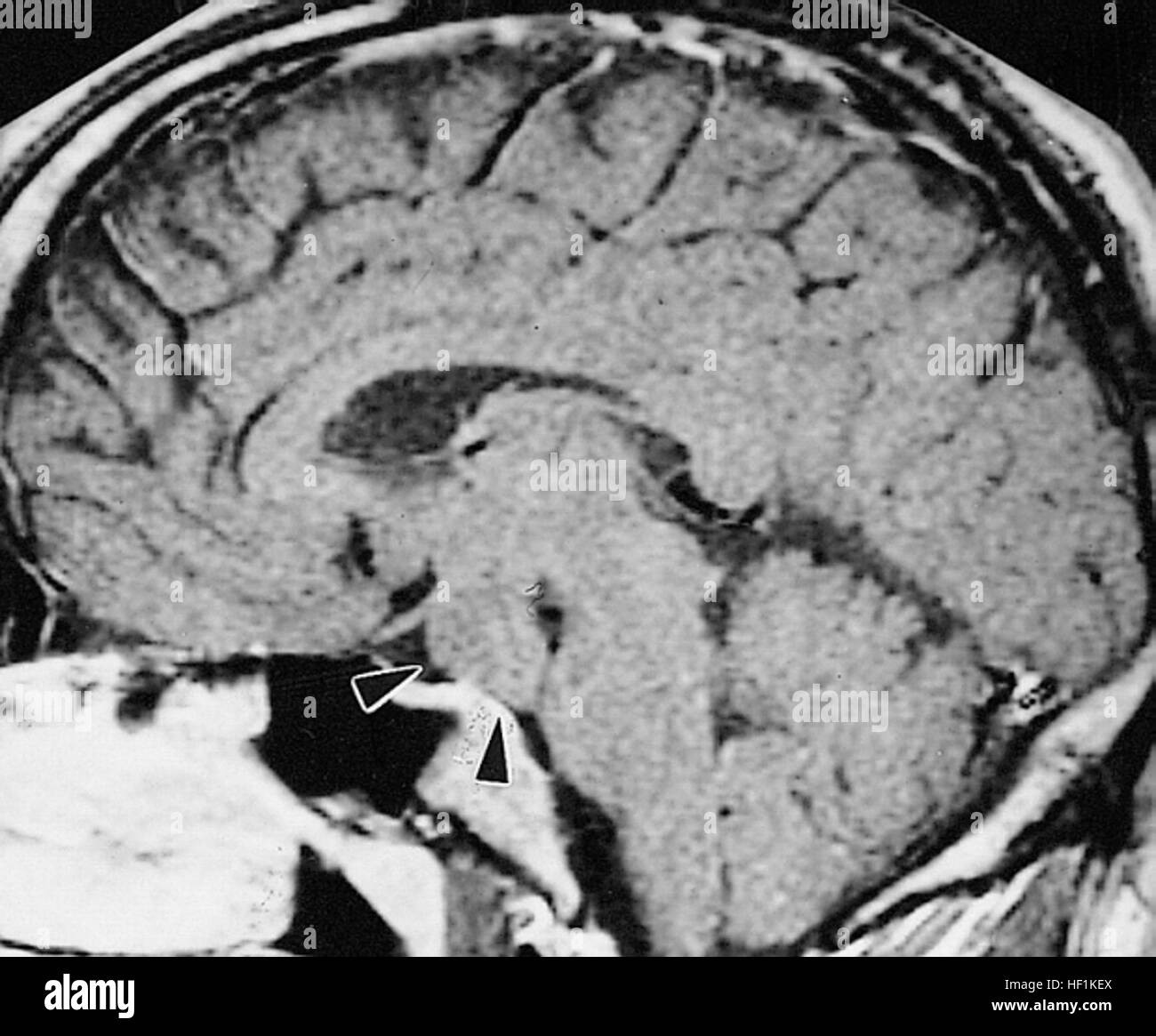 Brain developmental Black and White Stock Photos & Images - Alamy