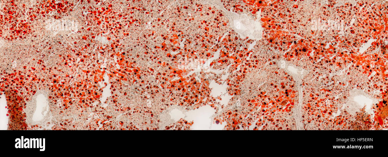 Fatty liver hi-res stock photography and images - Alamy