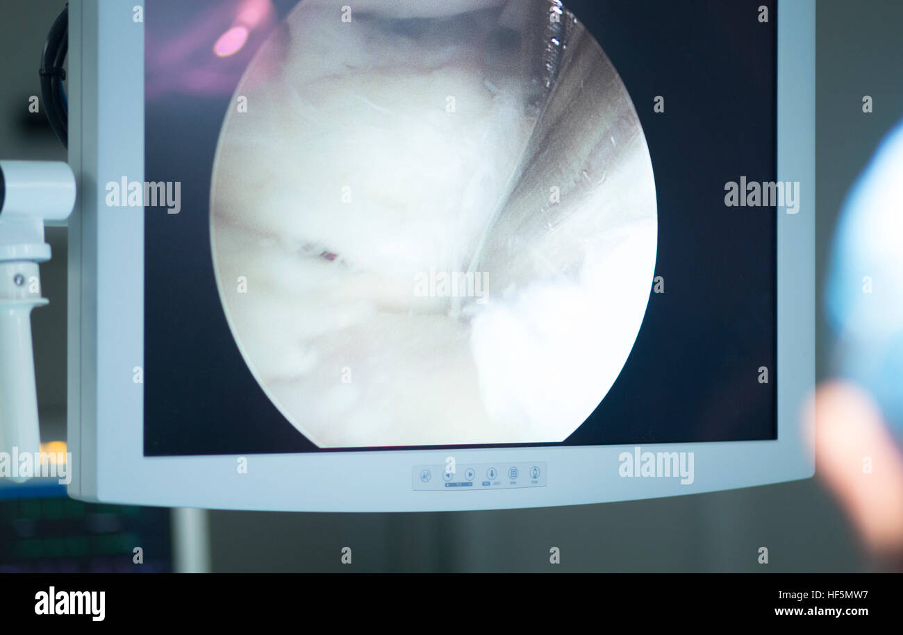 Arthroscopy surgery screen showing arthroscope camera picture in knee ...