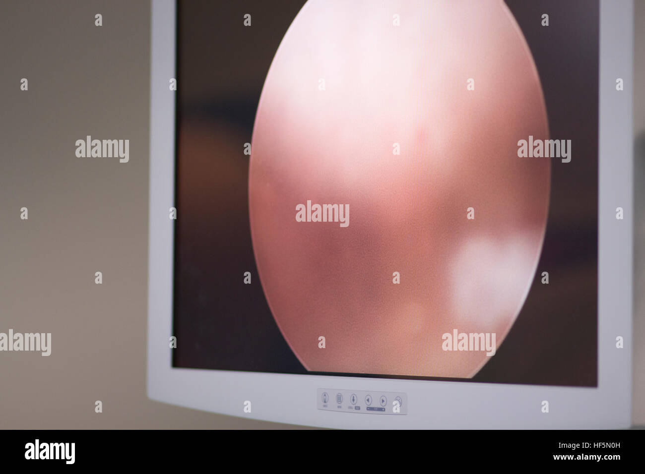 Arthroscopy surgery screen showing arthroscope camera picture in knee ...