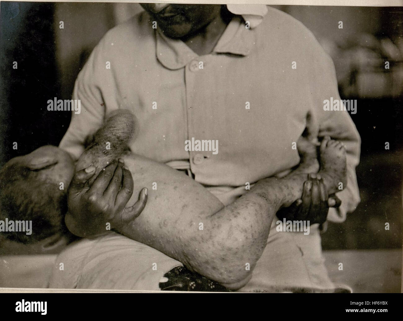 Villach, Sanitary Commission. 10. Smallpox in a girl, World War I ...