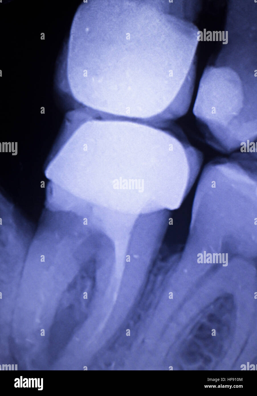 Tooth with filling dental x-ray close-up image showing teeth roots, gum ...
