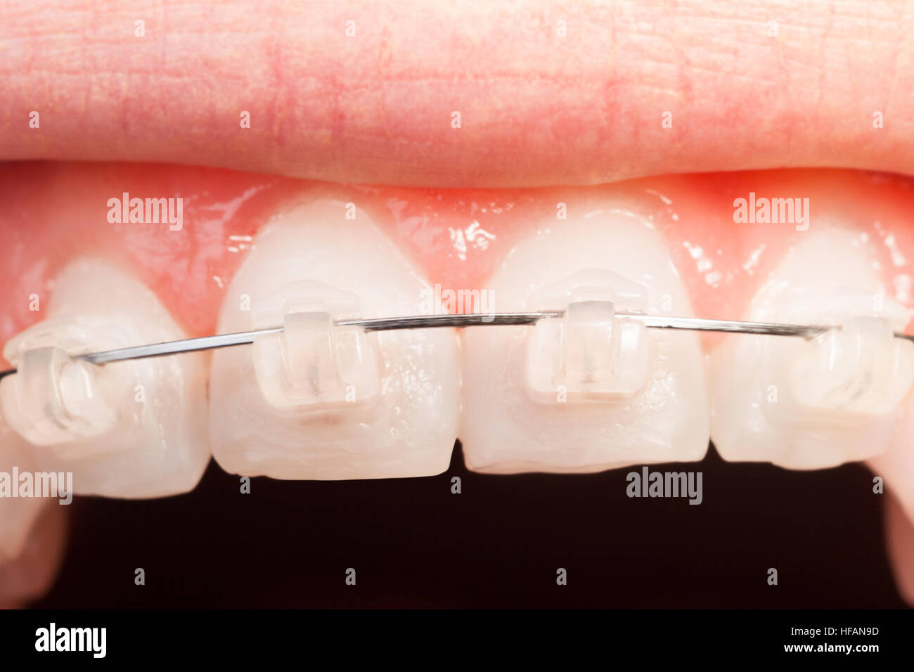 Top tooth alignment with ceramic braces Stock Photo - Alamy