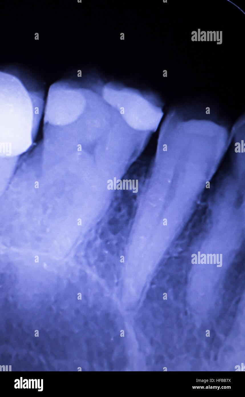Tooth with filling dental x-ray close-up image showing teeth roots, gum ...