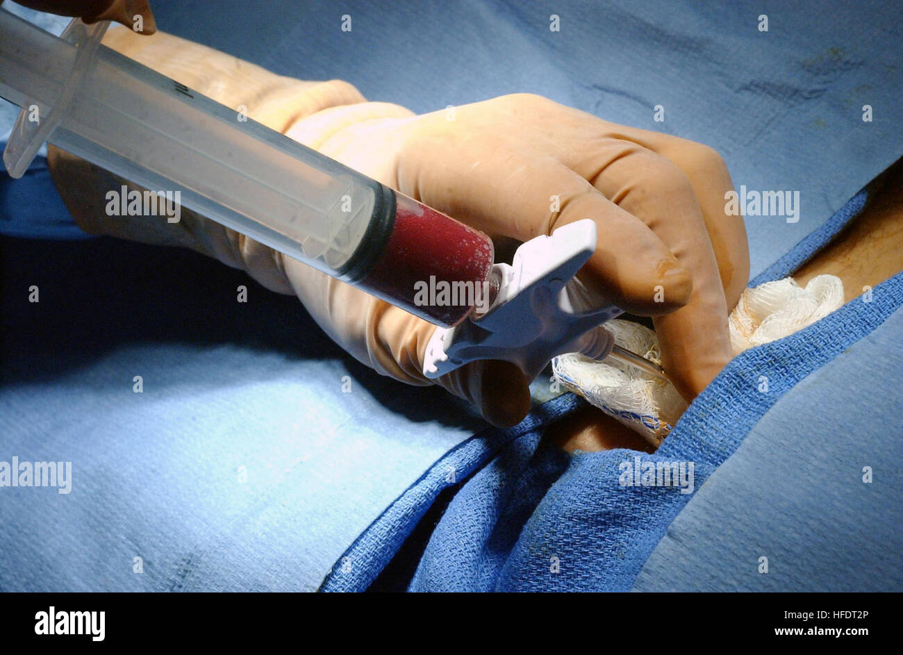 Bone marrow transplant operation hi-res stock photography and images ...