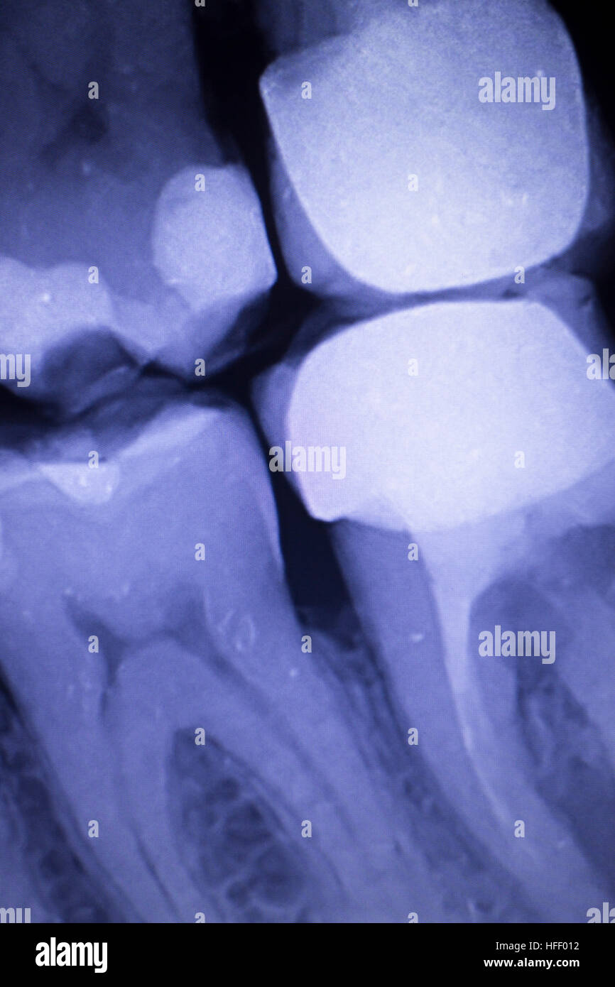 Tooth with filling dental x-ray close-up image showing teeth roots, gum ...