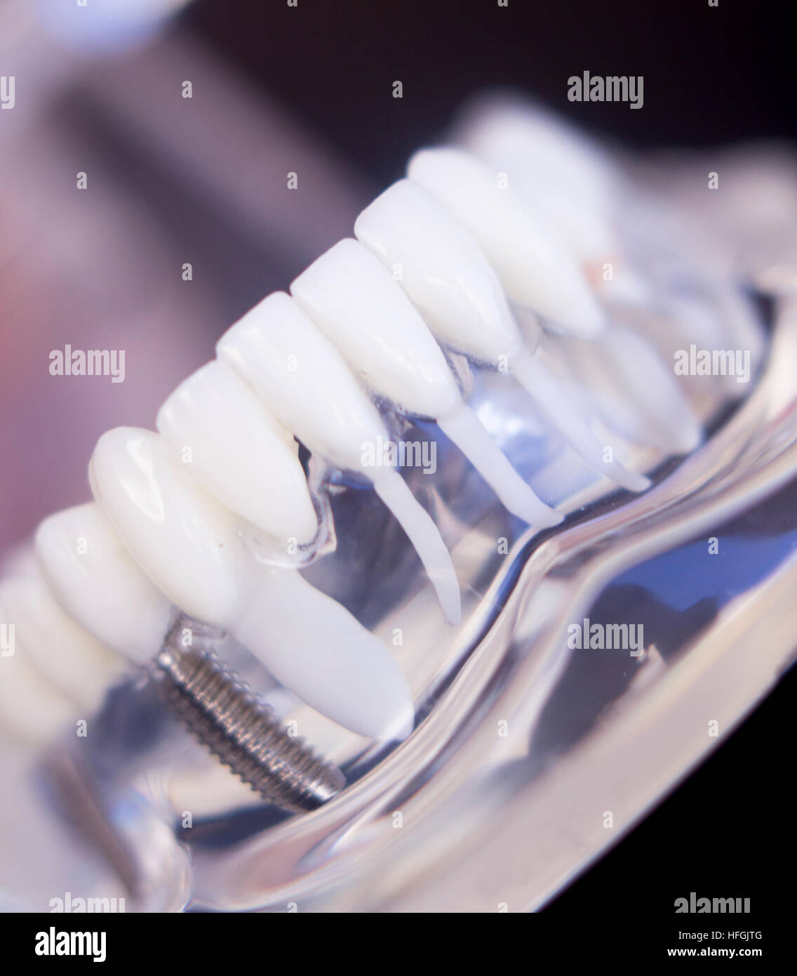 Dentists tooth plastic model with screw implant for teaching, learning ...