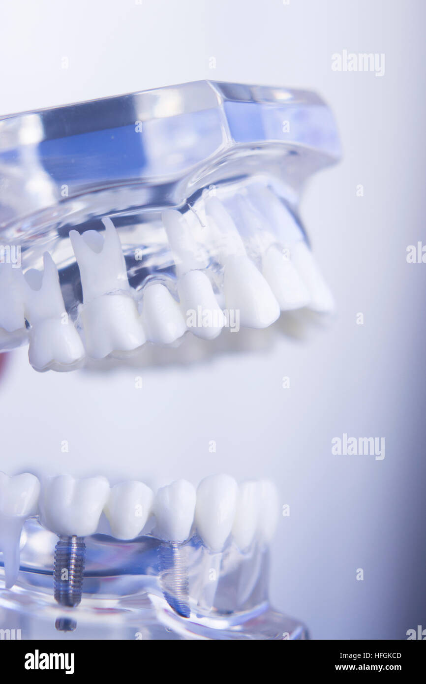 Dentists tooth plastic model with screw implant for teaching, learning ...