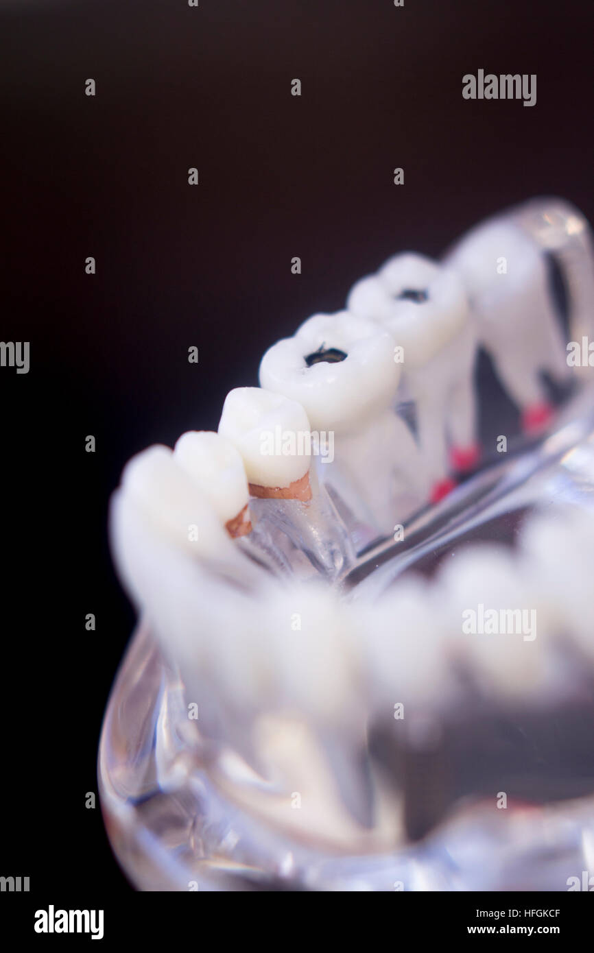 Dentists tooth plastic model with decay used for teaching, learning and ...