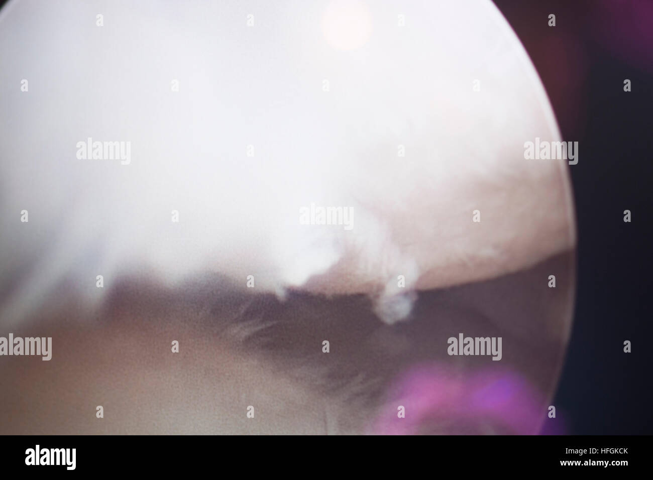 Arthroscopy surgery screen showing arthroscope camera picture in knee ...