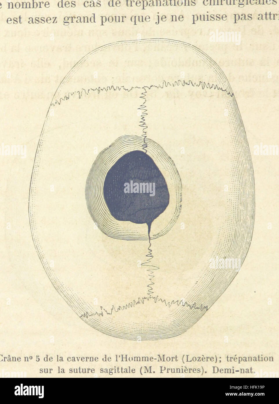 Trepanation neolithic hi-res stock photography and images - Alamy