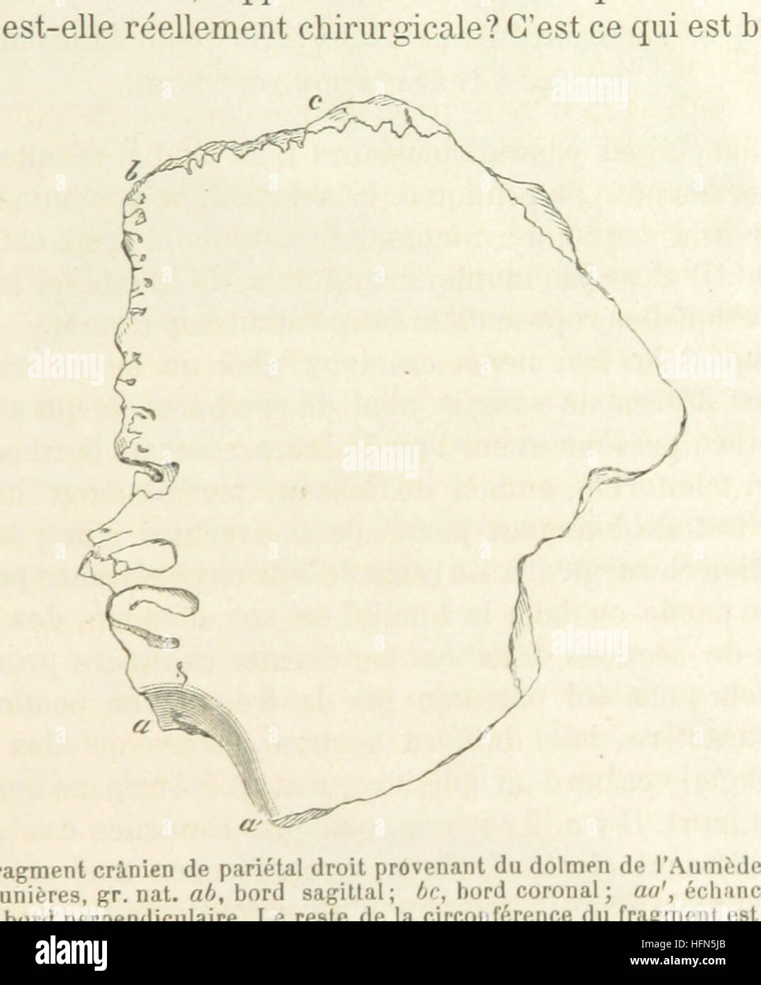 Trepanation neolithic hi-res stock photography and images - Alamy