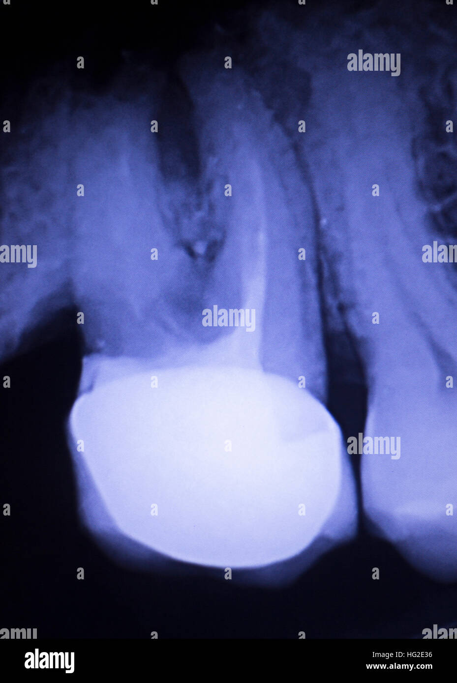 Tooth with filling dental x-ray close-up image showing teeth roots, gum ...