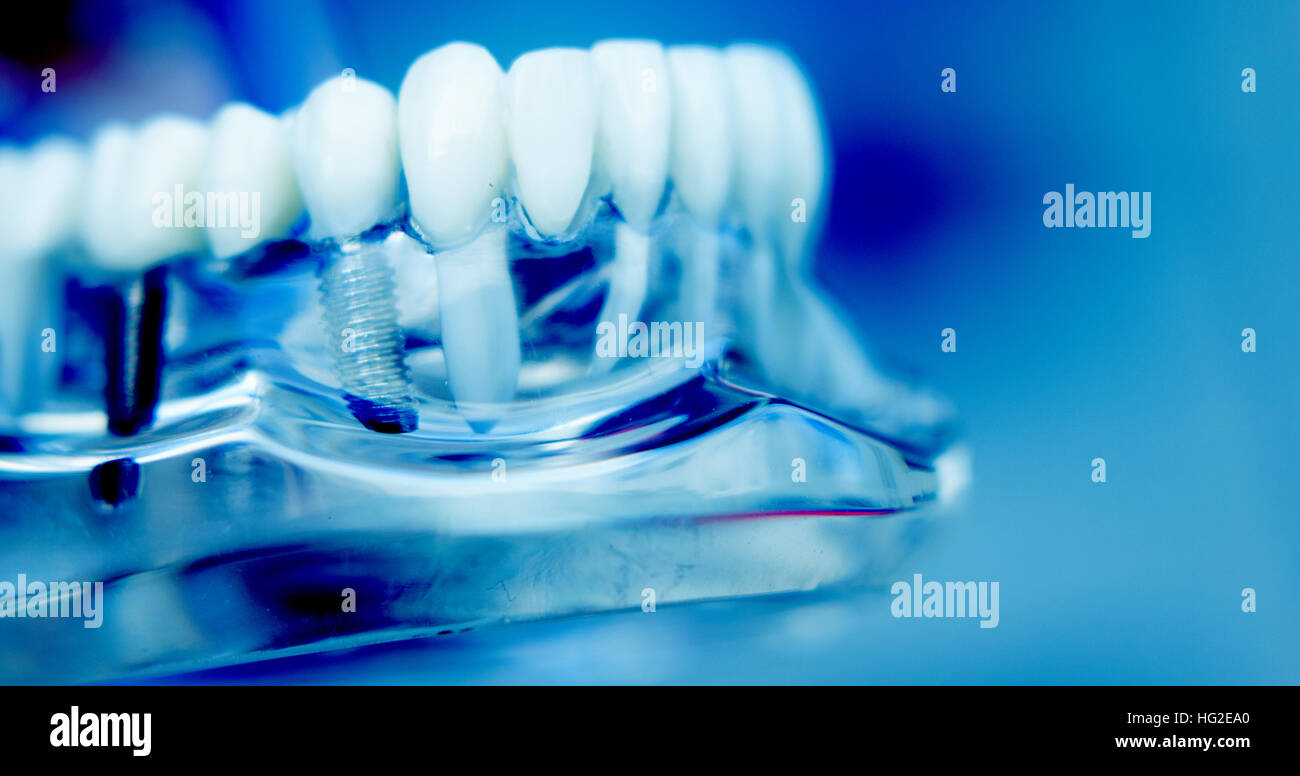 Dentists tooth plastic model with screw implant for teaching, learning ...