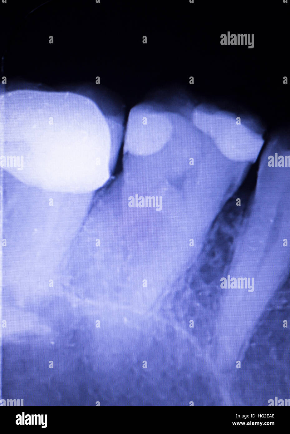 Tooth with filling dental x-ray close-up image showing teeth roots, gum ...
