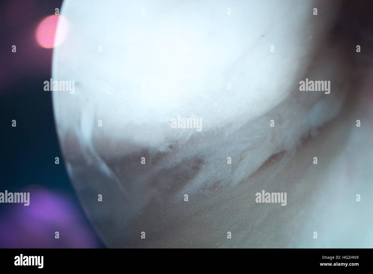 Arthroscopy surgery screen showing arthroscope camera picture in knee ...