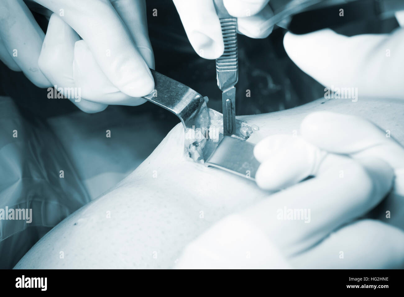 Surgical operation knee arthroscopy micro surgery on knee, tendon ...