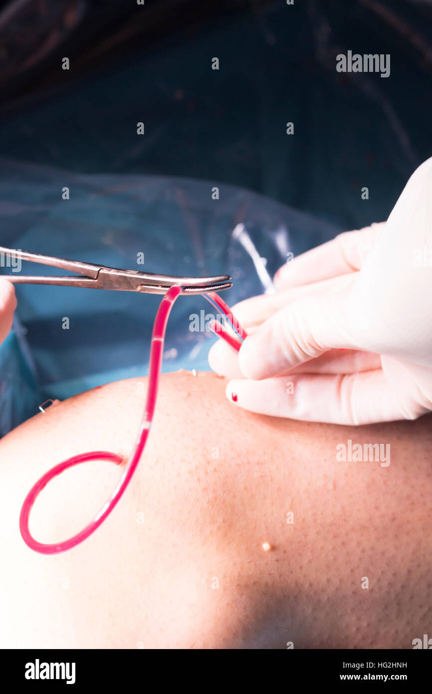 Surgical operation knee arthroscopy micro surgery in hospital operating ...